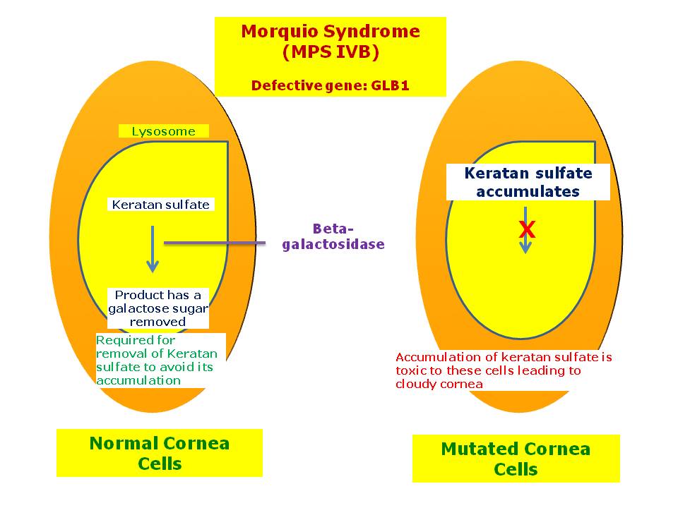 Morquio Syndrome Mps Ivb Hereditary Ocular Diseases